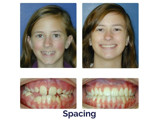 Before After Orthodontic Treatment Baton Rogue LA | Porter Orthodontics