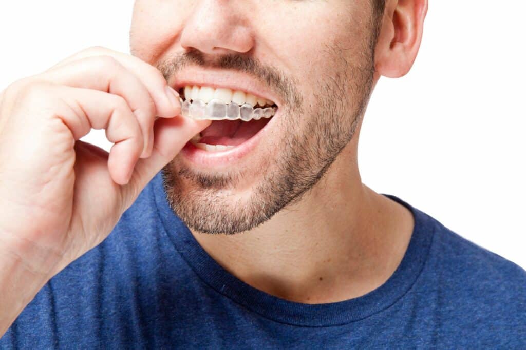 How to Clean Invisalign Aligners Properly in Baton Rouge, LA